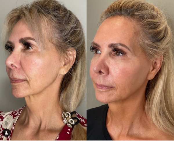 PDO Thread Lift Near Me | Facial Threading | West Palm Beach