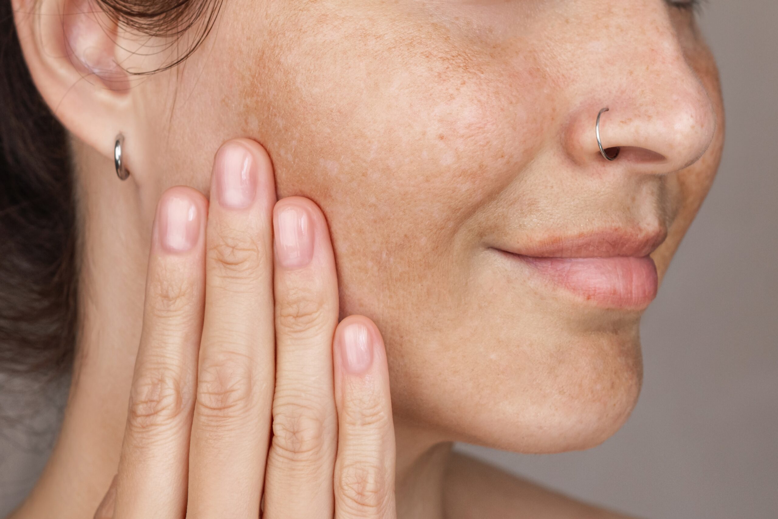 Treating Sun-Damaged Skin with CoolPeel - Galiderm Aesthetics and ...